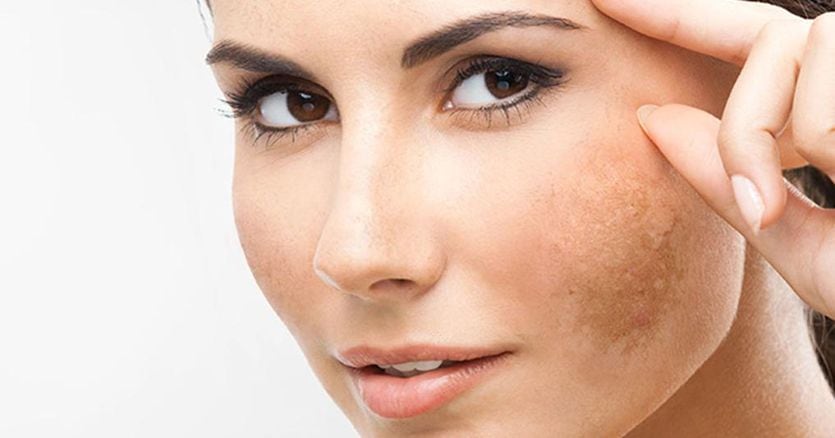 Macchie cutanee: cause, prevenzione e trattamenti efficaci - Il Sole 24 ORE