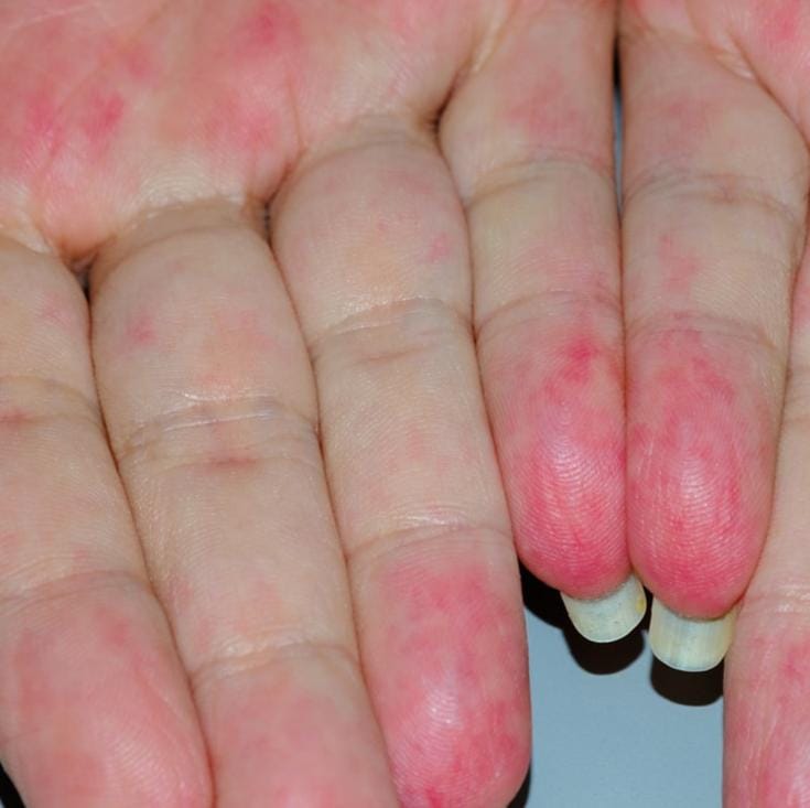 mild vasculitis hands