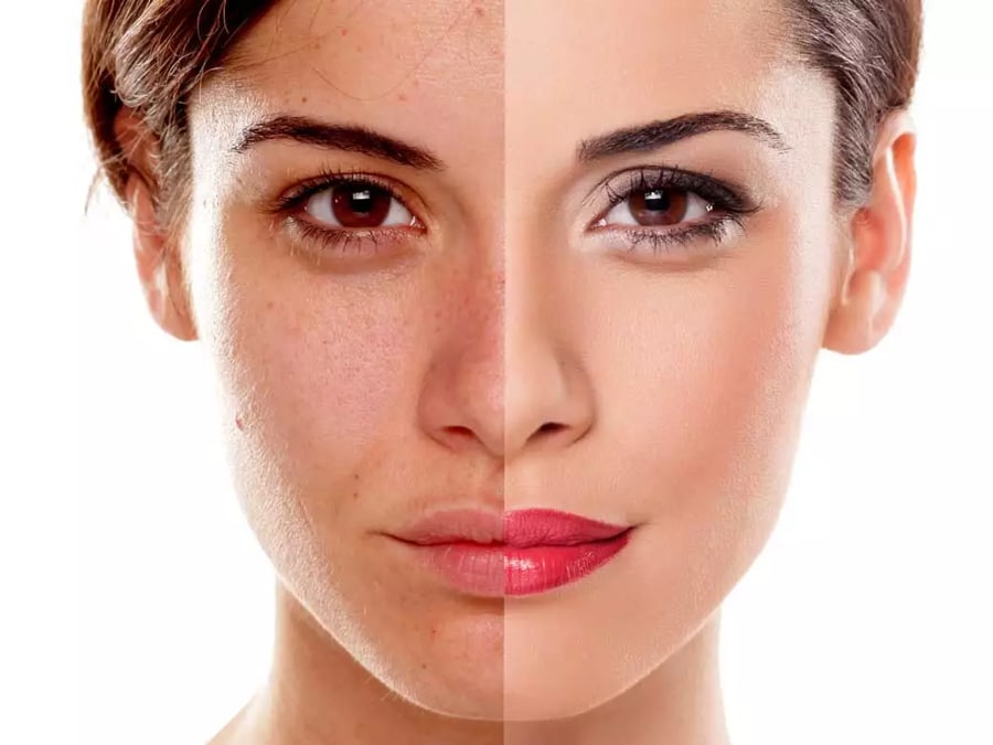 Macchie cutanee, le novità per eliminarle tra peeling, tonici e sieri ...